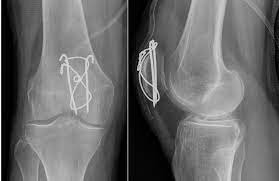 Fractura de rótula. Técnicas de cerclaje. :: Traumatologia Torner
